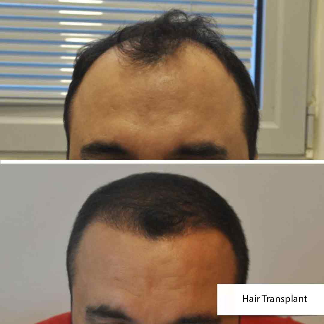 Hair Transplant In Turkey, Istanbul | Costs, Reviews 2025